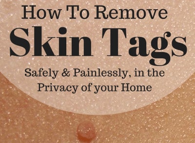 How To Remove Skin Tags At Home - TagBand & Home Remedies!