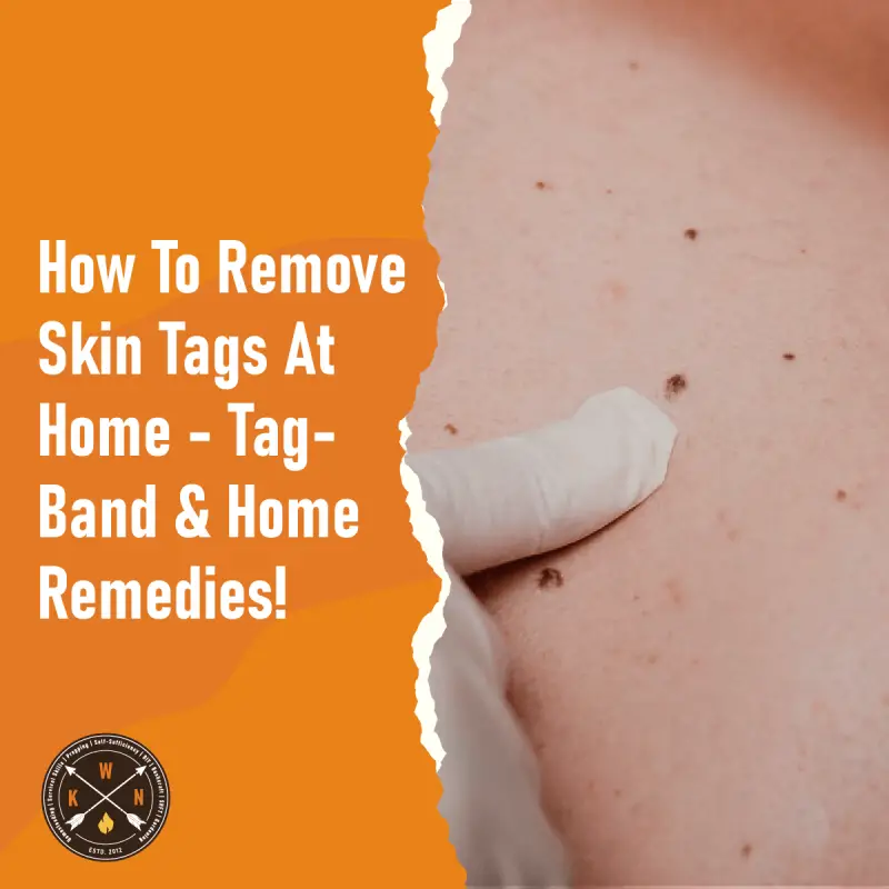How To Remove Skin Tags At Home - TagBand & Home Remedies!